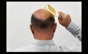 When Family History Catches Up: Treating Hereditary Balding ...